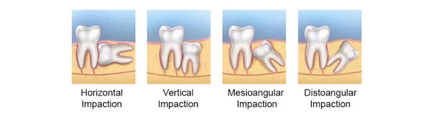 Impactions Kiwi Dental Hospitals and Dental Implants Center